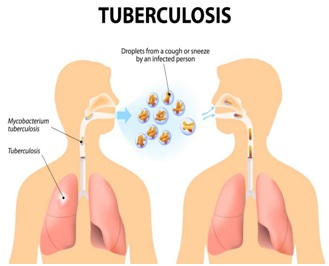 World Tuberculosis Day